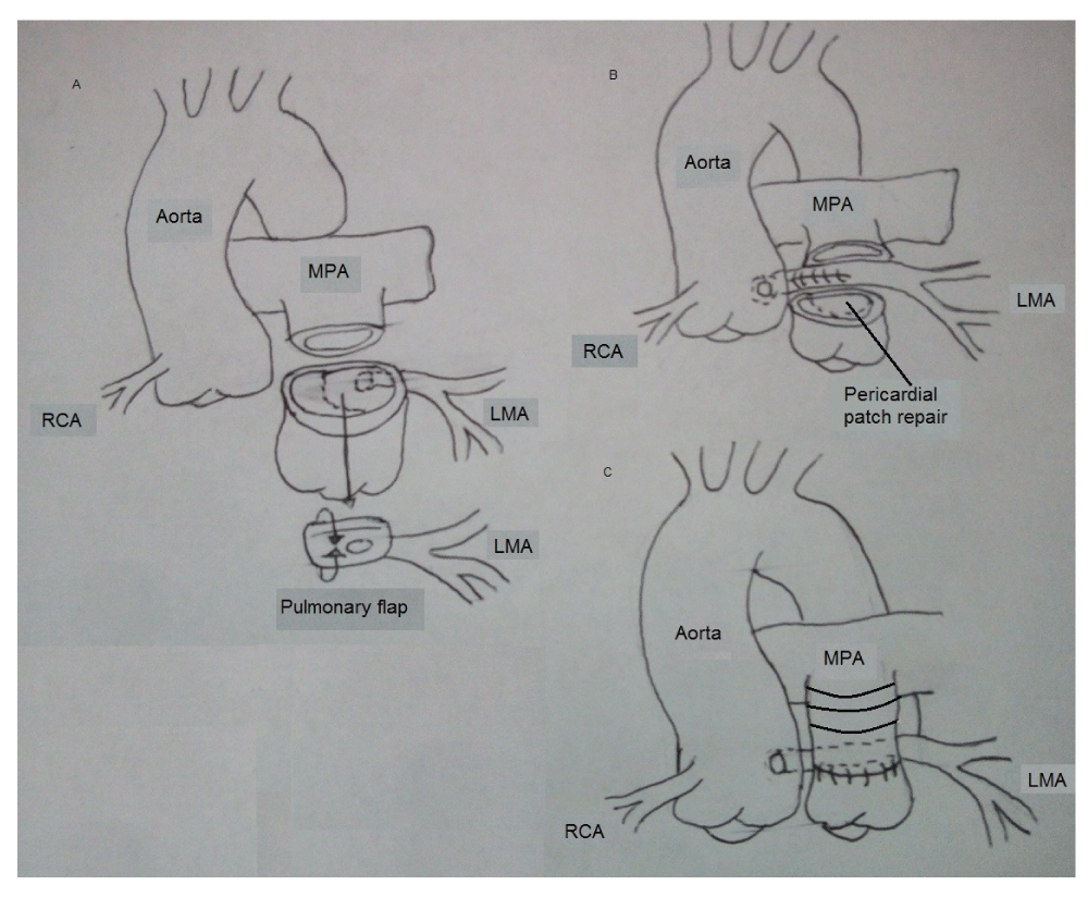 Case Report: ALCAPA syndrome: successful repair... | F1000Research