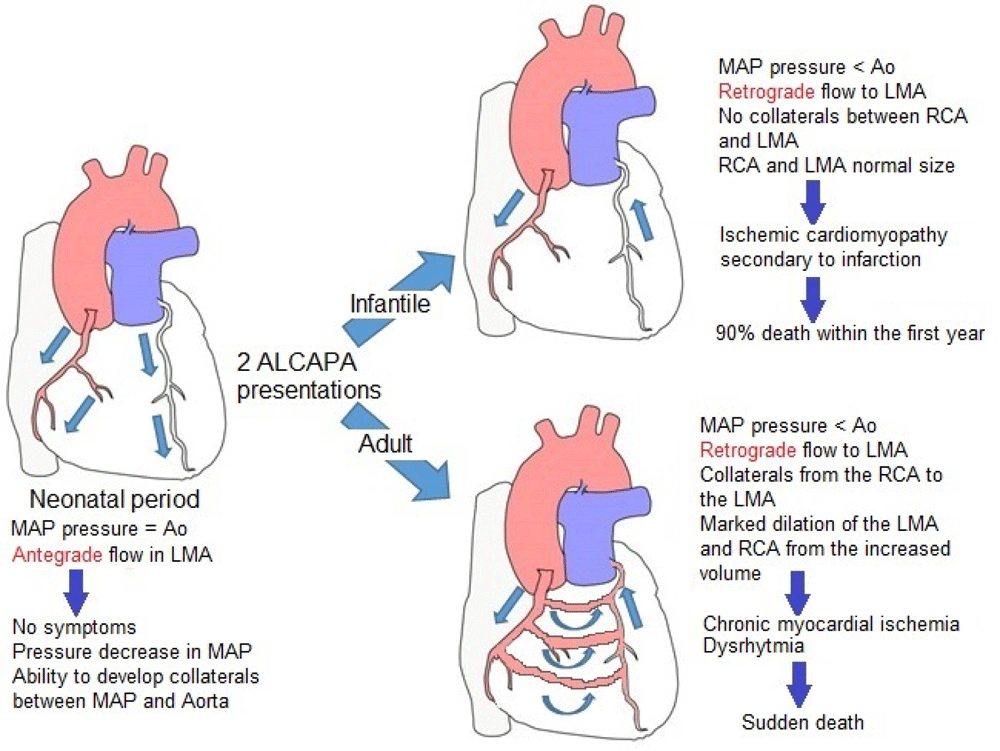 Case Report: ALCAPA syndrome: successful repair... | F1000Research