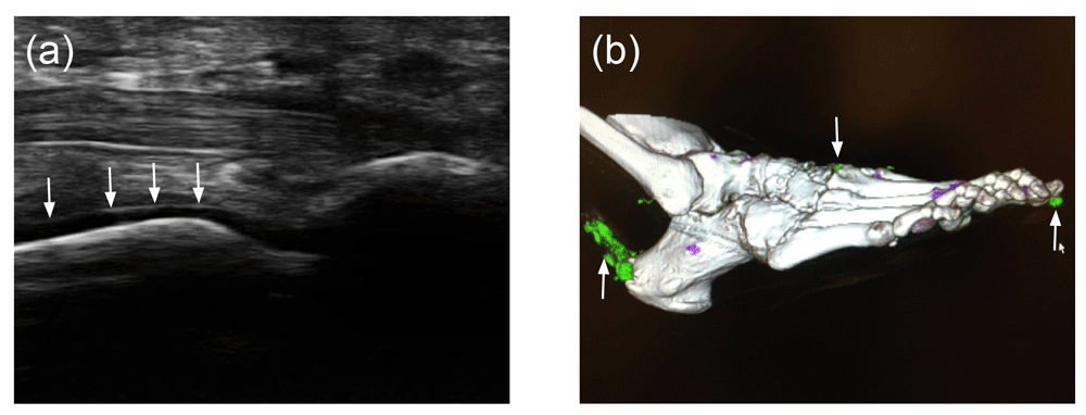 Recent advances in understanding and managing gout | F1000Research