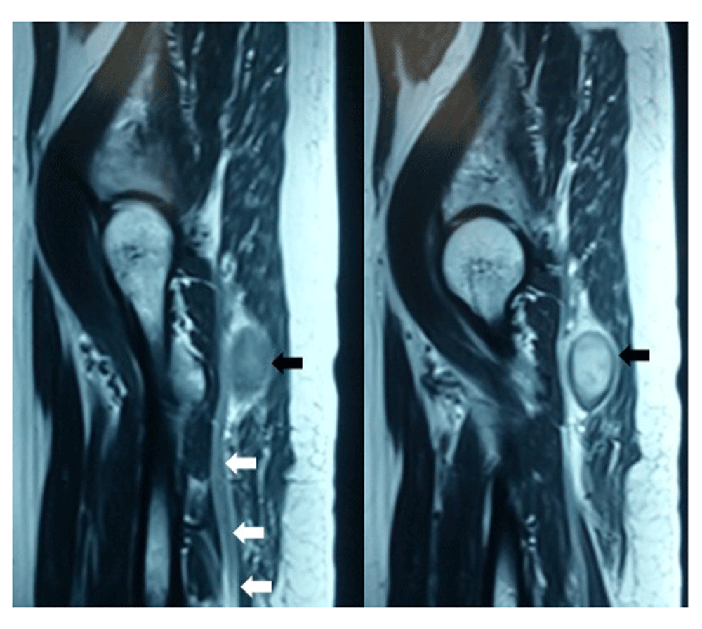 Case Report: Sciatic nerve schwannoma - a rare... | F1000Research