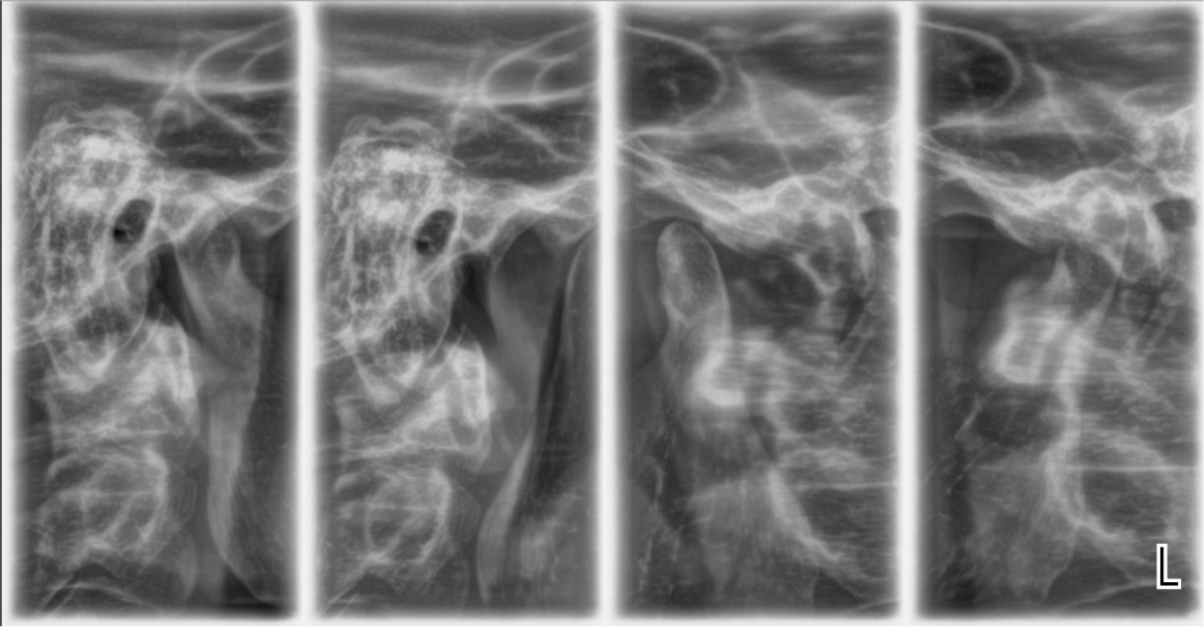 Case Report: Digital analysis of occlusion with... | F1000Research