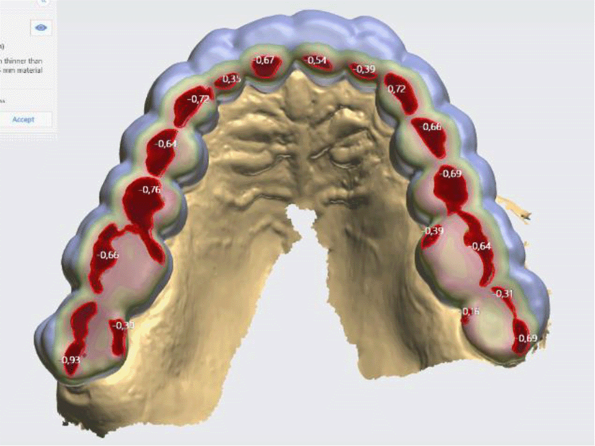Case Report: Digital analysis of occlusion with... | F1000Research