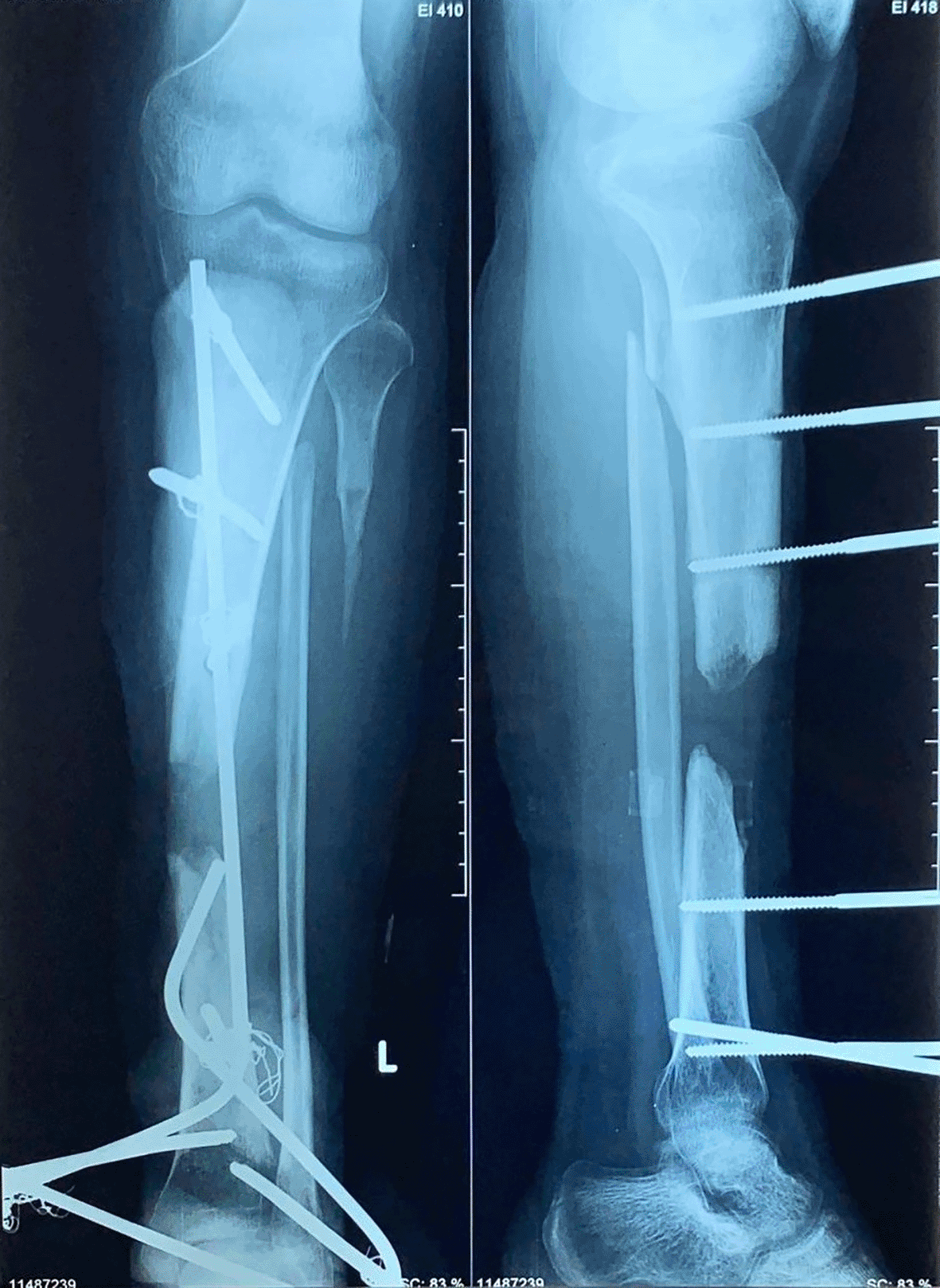 Case Report: Large bone defect... | F1000Research