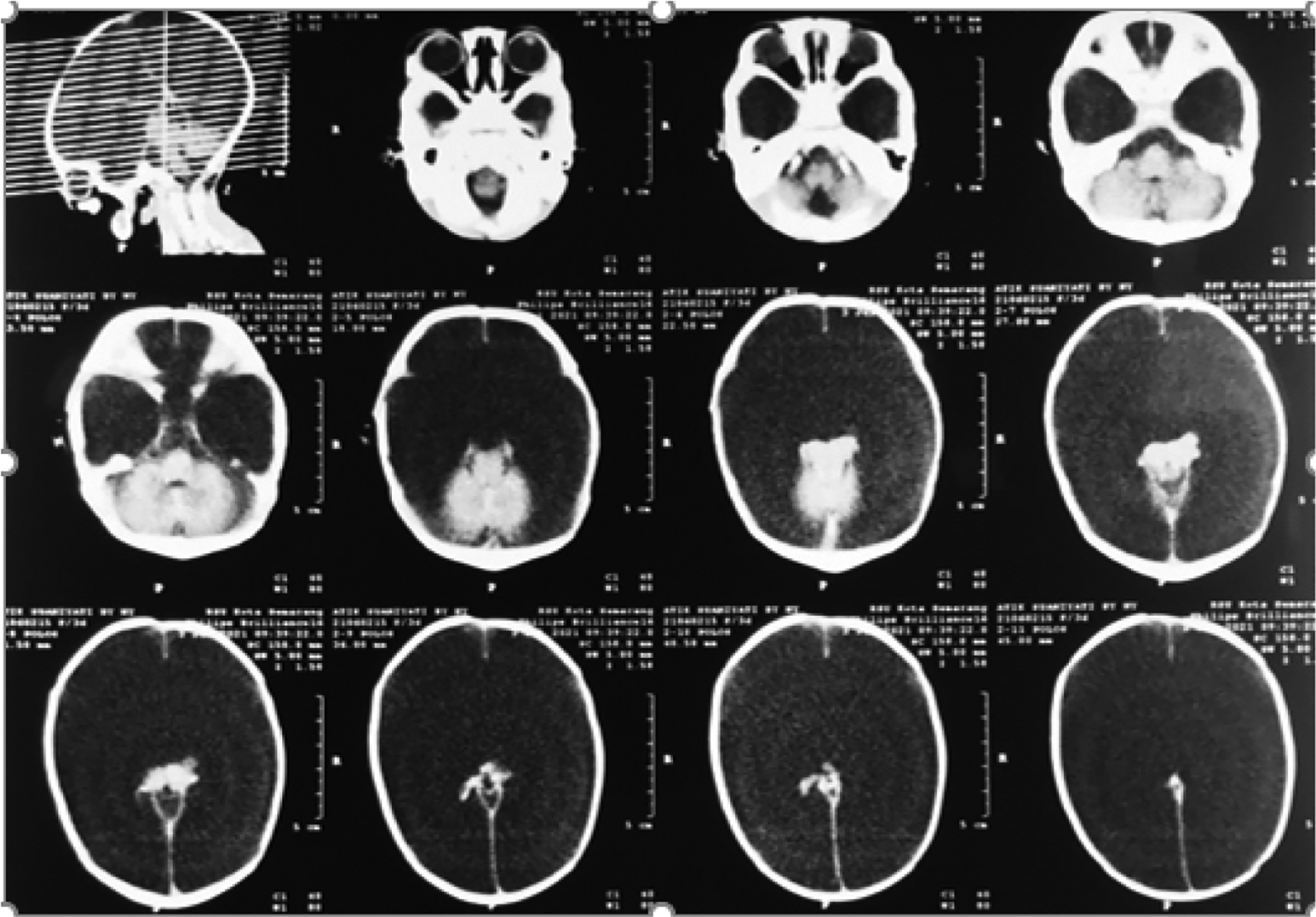 Case Report: Hydranencephaly in a female newborn... | F1000Research