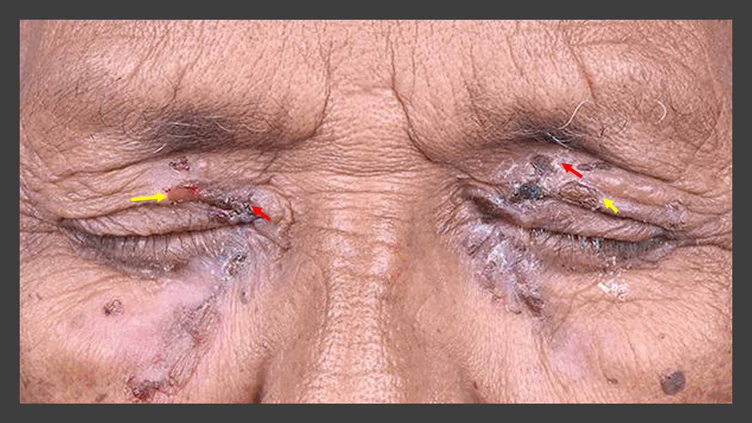 A case series of ocular involvement in bullous... | F1000Research