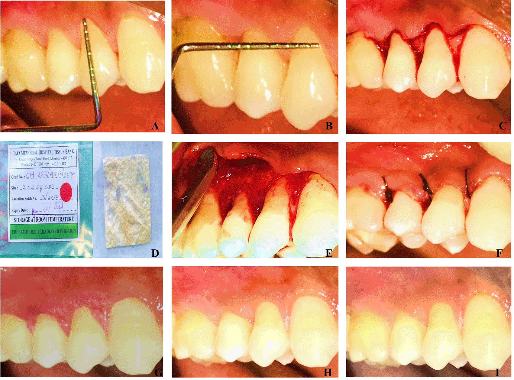 Title-comparison of coronally advanced flap with... | F1000Research