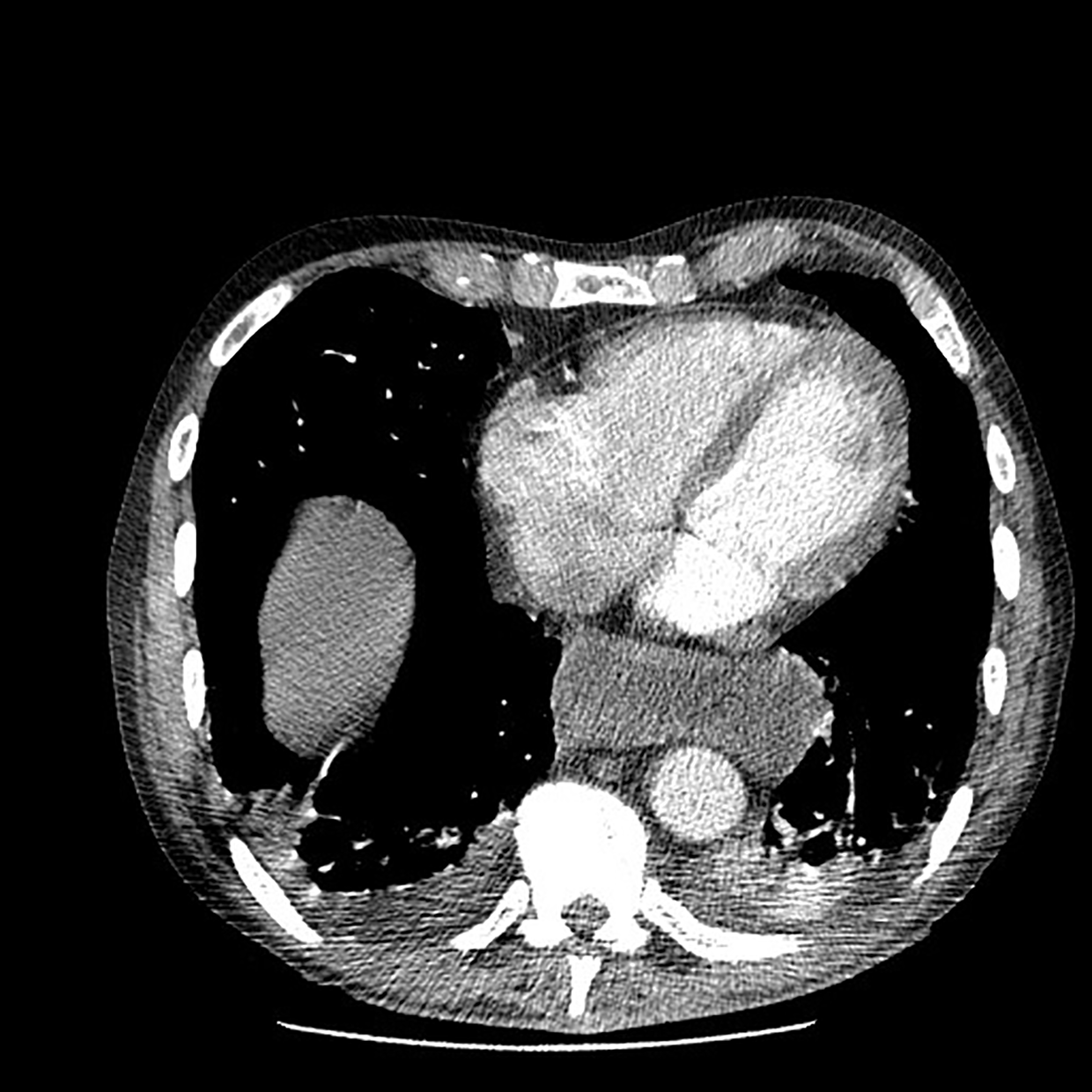 Case Report: Bocavirus Infection Radiologically... | F1000Research