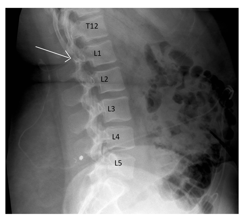 Lumboperitoneal shunt insertion without fluoroscopy... | F1000Research