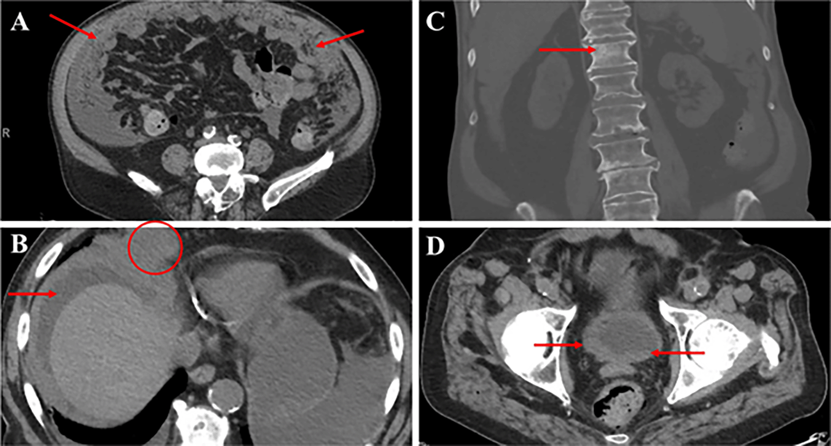 Case Report: A rare presentation of prostate cancer... | F1000Research