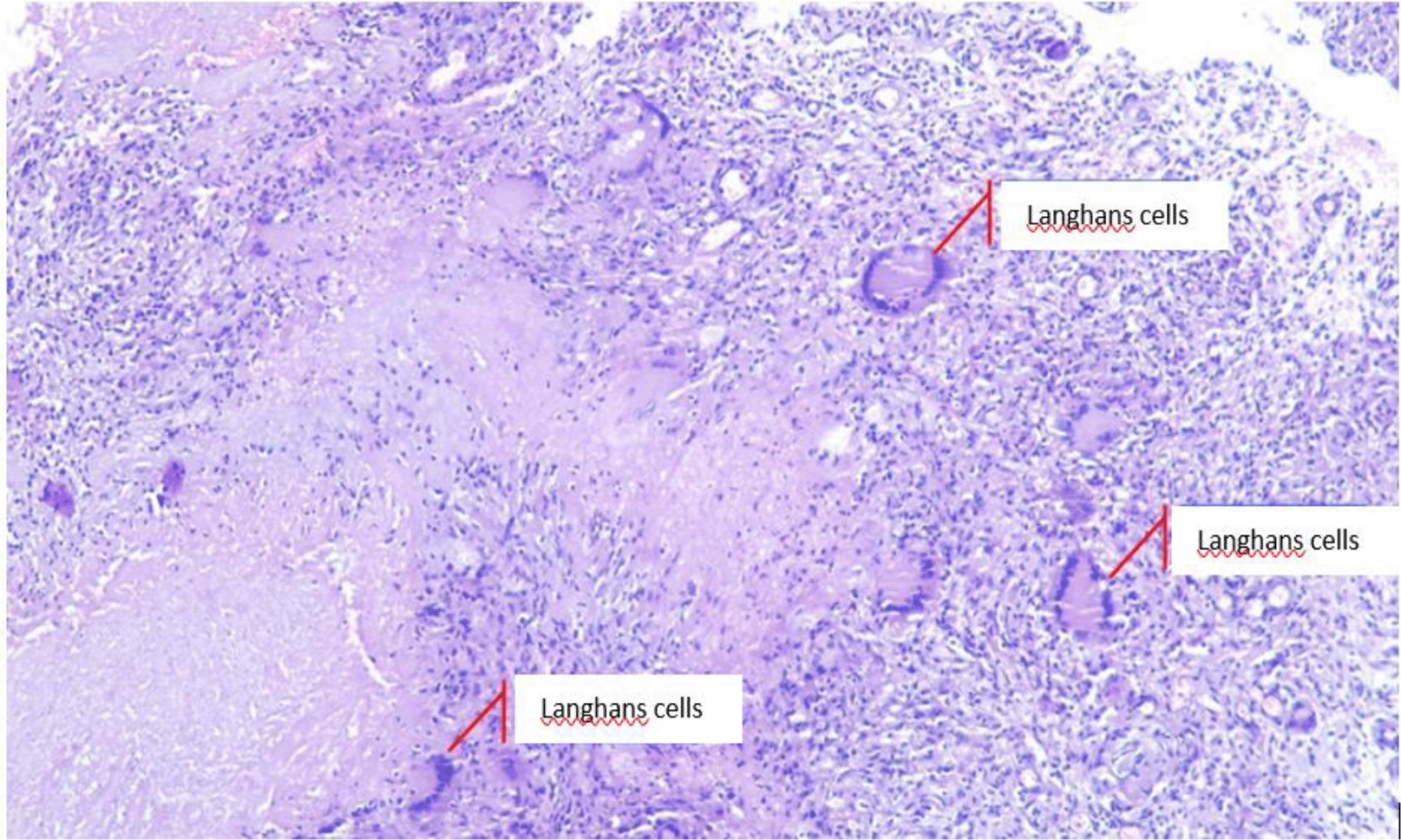 Case Report: Delayed treatment of tuberculosis of... | F1000Research