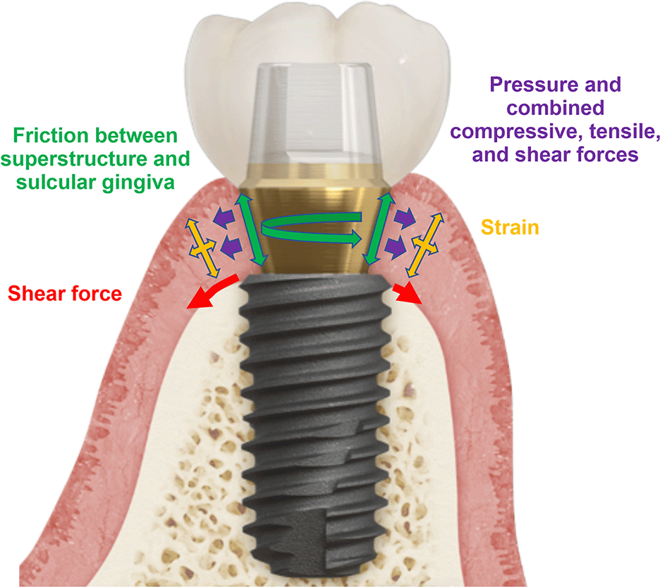 Deep tissue injury as possible pathogenesis of... | F1000Research