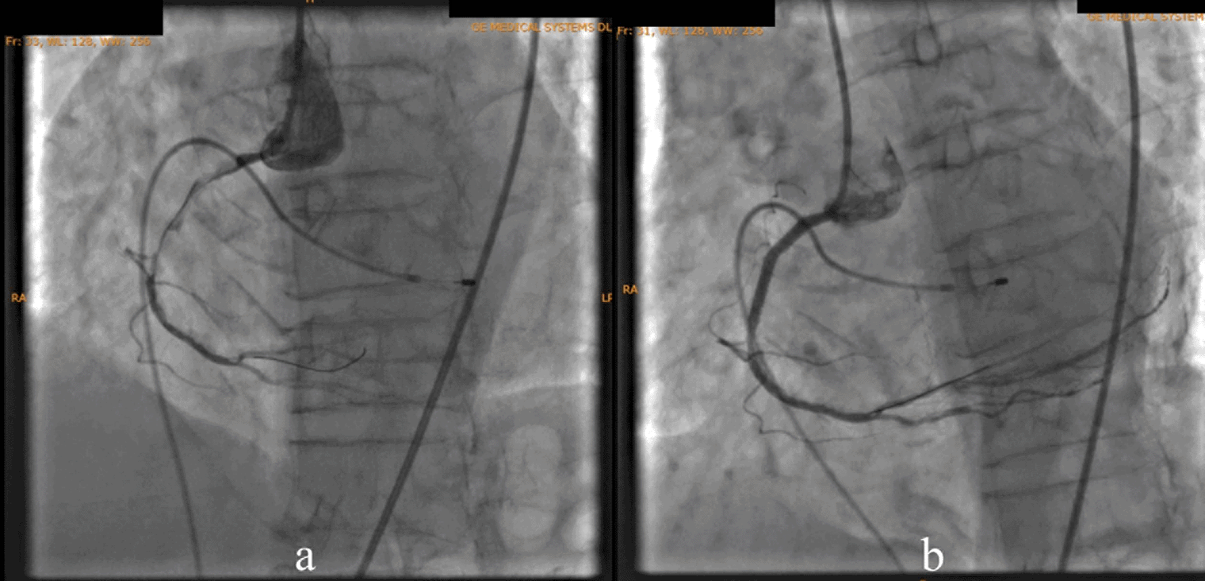 Case Report: Successful primary percutaneous... | F1000Research