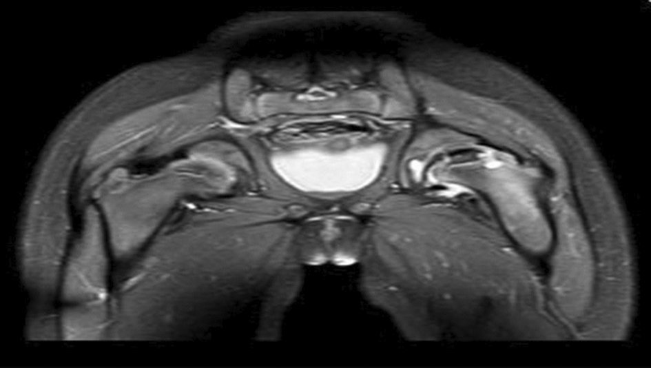Case Report: A case of stiff skin syndrome from a... | F1000Research