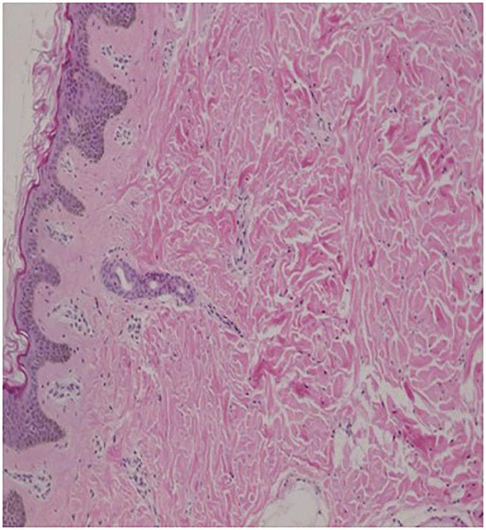 Case Report: A case of stiff skin syndrome from a... | F1000Research