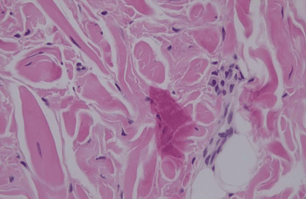 Case Report: A case of stiff skin syndrome from a... | F1000Research