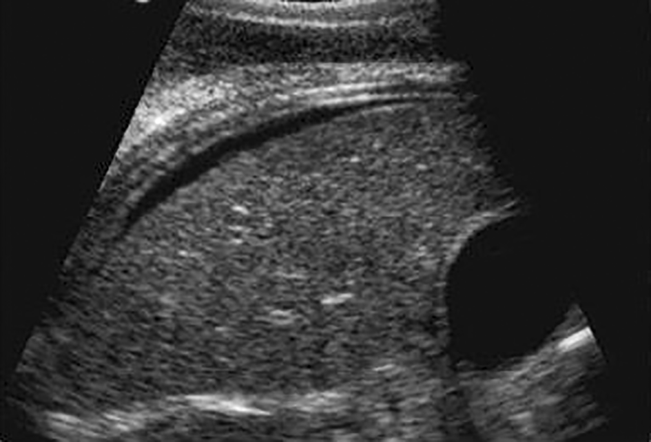 Case Report: Ovarian fibroma: typical... | F1000Research