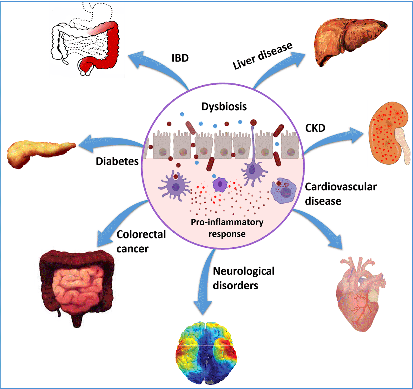 Dysbiosis: Gut feeling | F1000Research