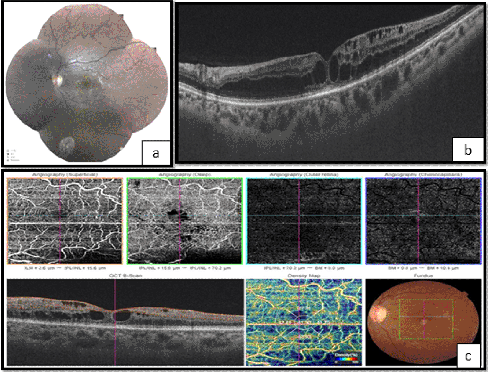 Case Report: Optical coherence tomography... | F1000Research