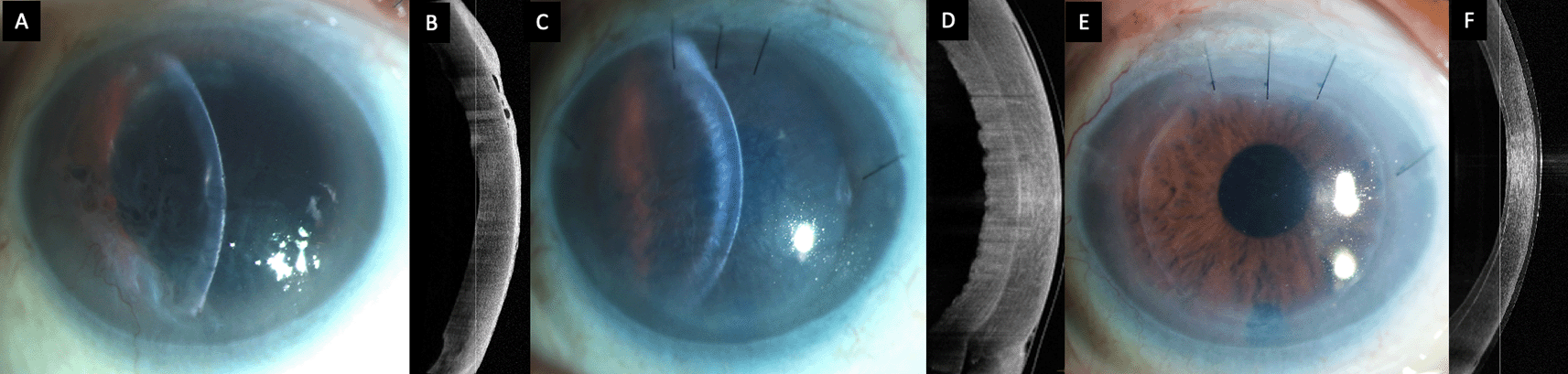 Case Report: Primary graft failure due to a... | F1000Research