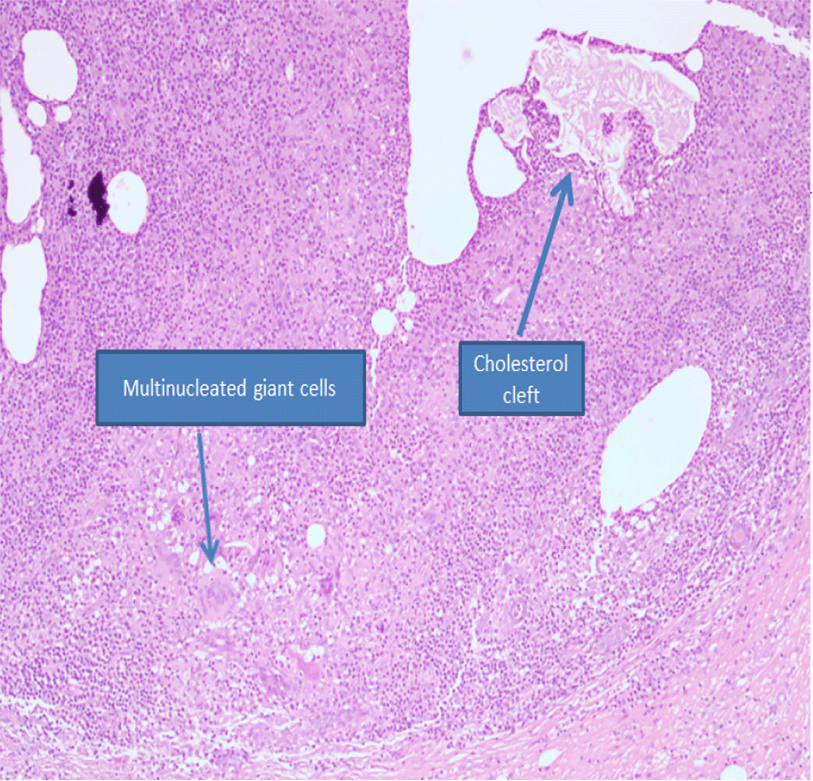Case Report: Open biopsy and drainage for breast... | F1000Research