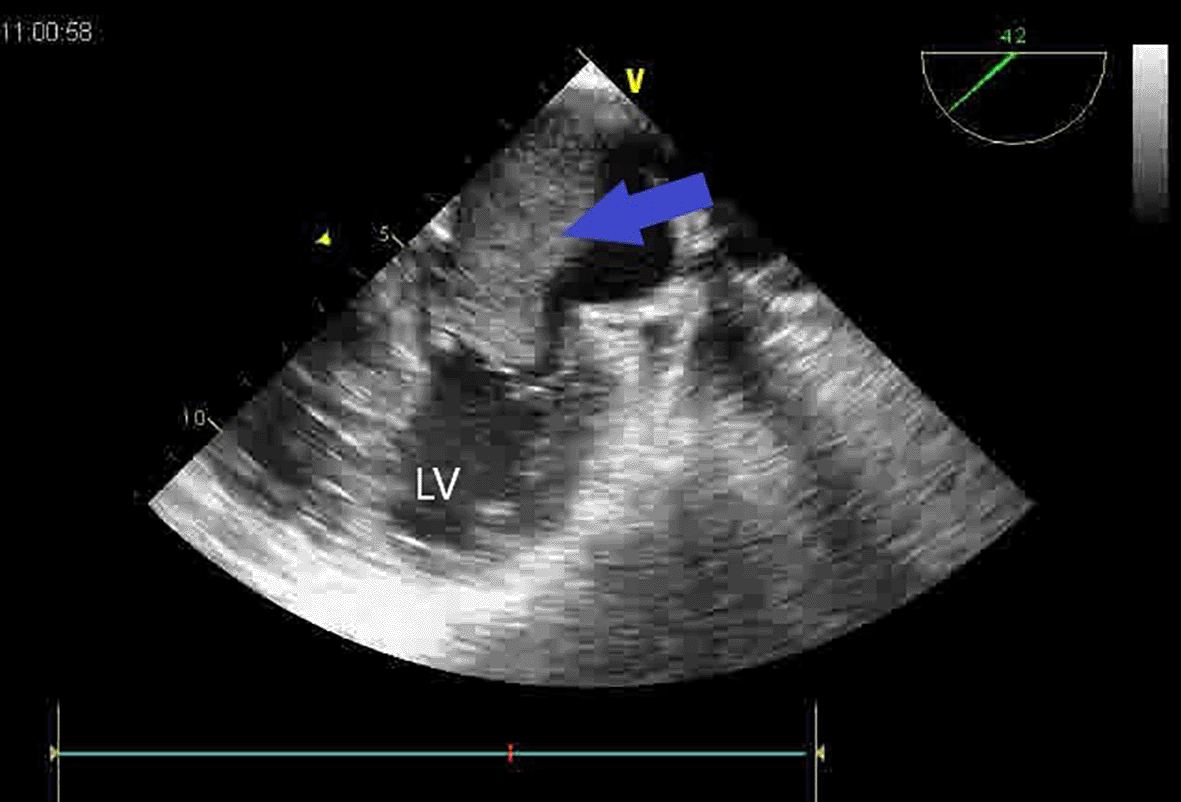 Case Report: Mitral valve obstruction by metastatic... | F1000Research