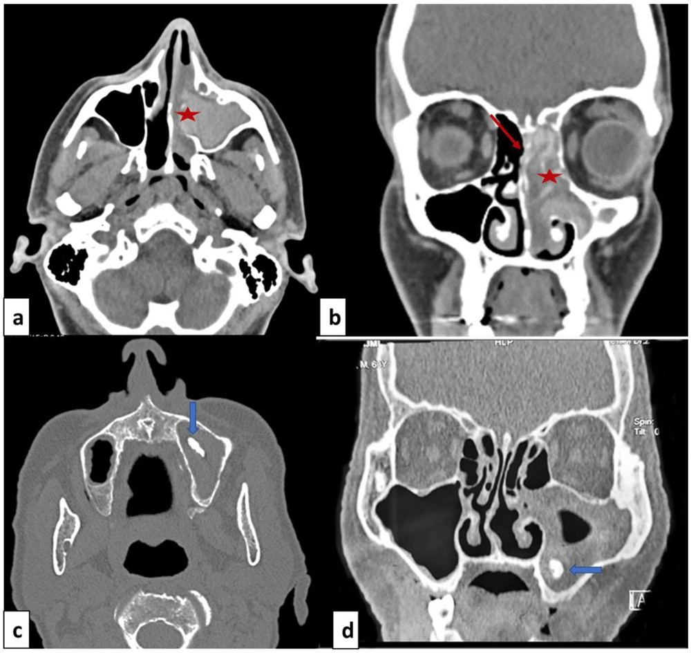 Noninvasive fungal rhinosinusitis: a case series | F1000Research