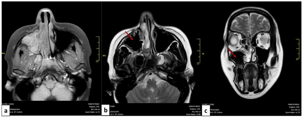 Noninvasive fungal rhinosinusitis: a case series | F1000Research