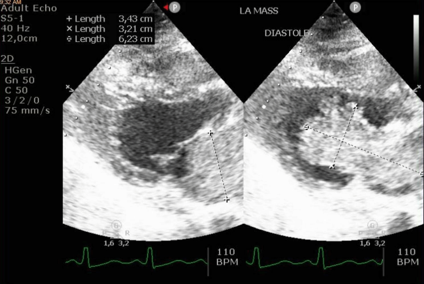 Case Report: Left atrial myxoma with confirmed... | F1000Research