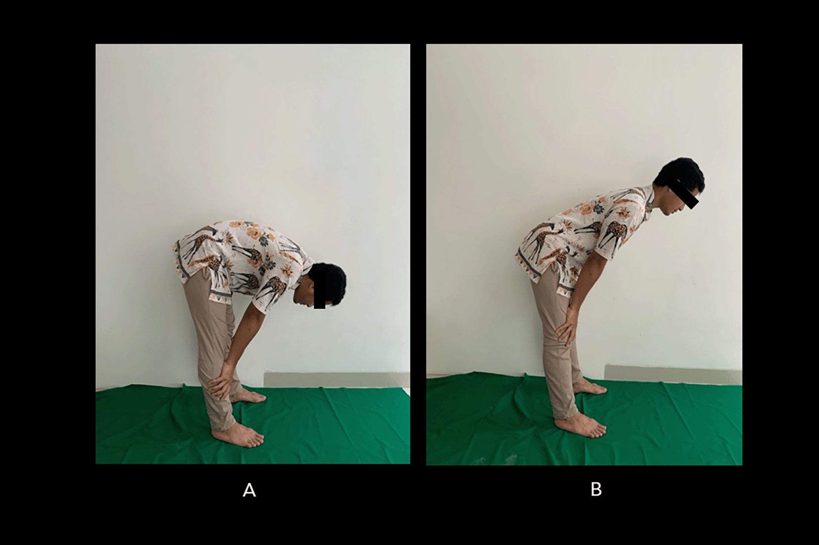 The impact of spinal fusion of adolescent... | F1000Research
