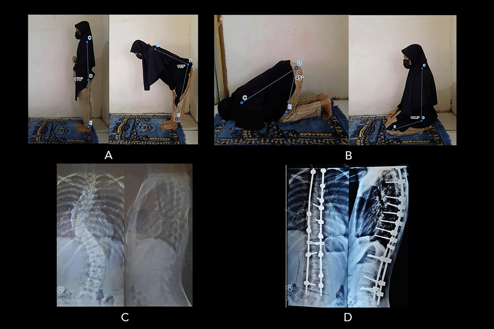 The impact of spinal fusion of adolescent... | F1000Research