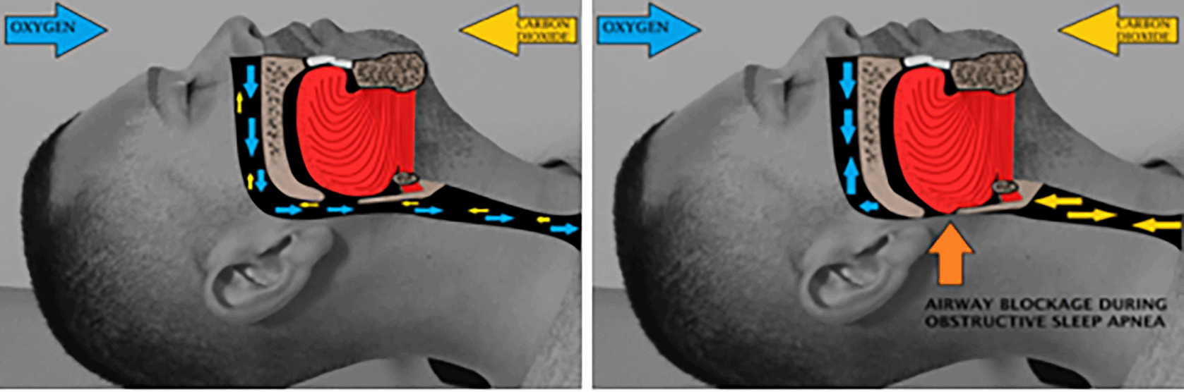 Detection of sleep apnea using polysomnographic... | F1000Research