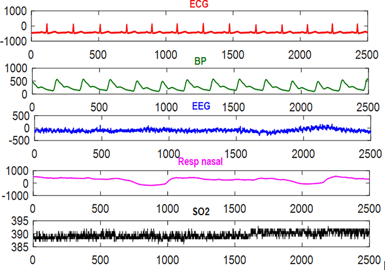 Detection of sleep apnea using polysomnographic... | F1000Research