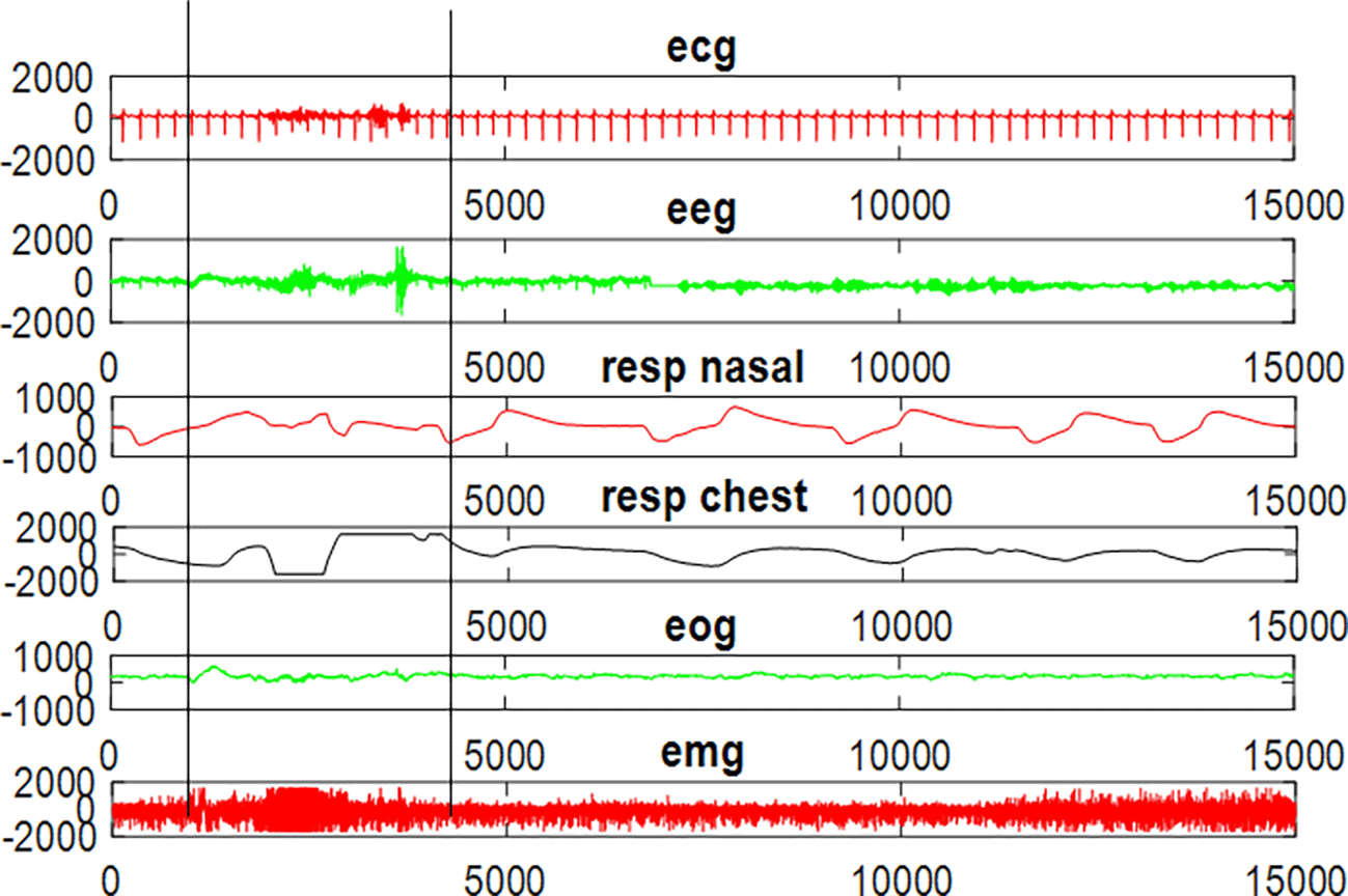 Detection of sleep apnea using polysomnographic... | F1000Research
