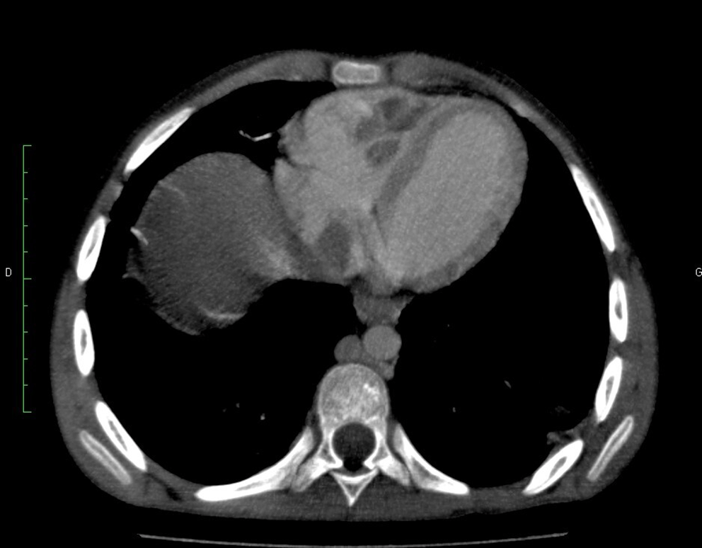 Case Report: Angio Behçet in a child | F1000Research