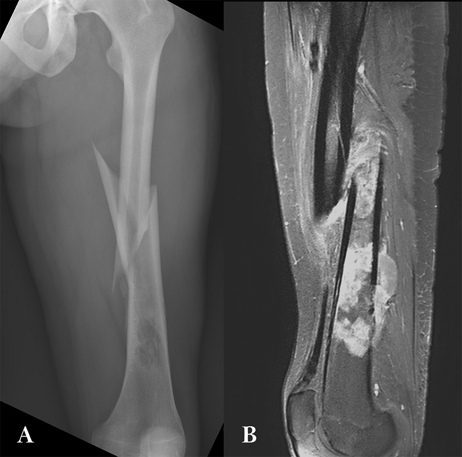 Case Report: Pathological fracture in a Li-Fraumeni... | F1000Research