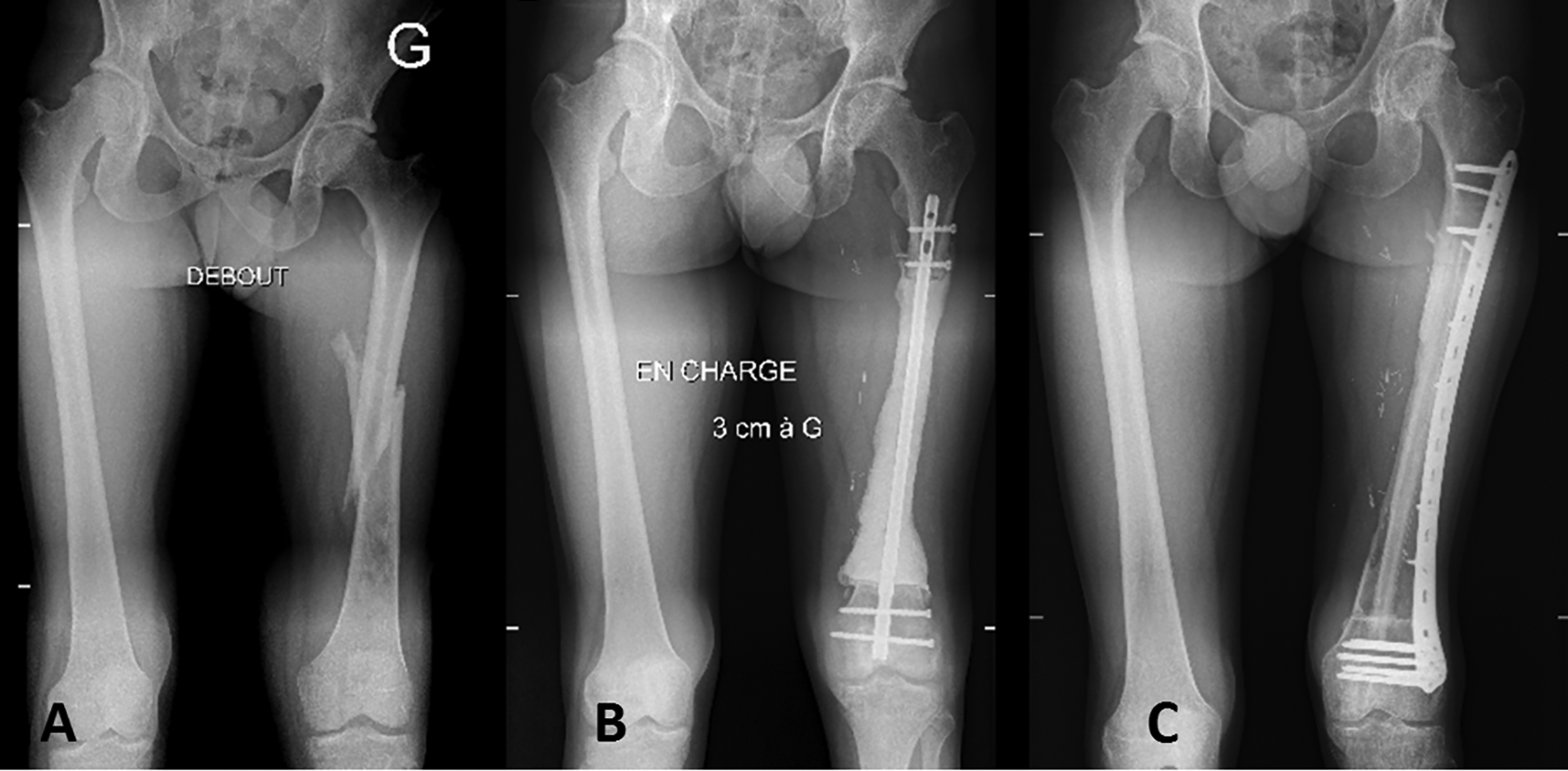 Case Report: Pathological fracture in a Li-Fraumeni... | F1000Research
