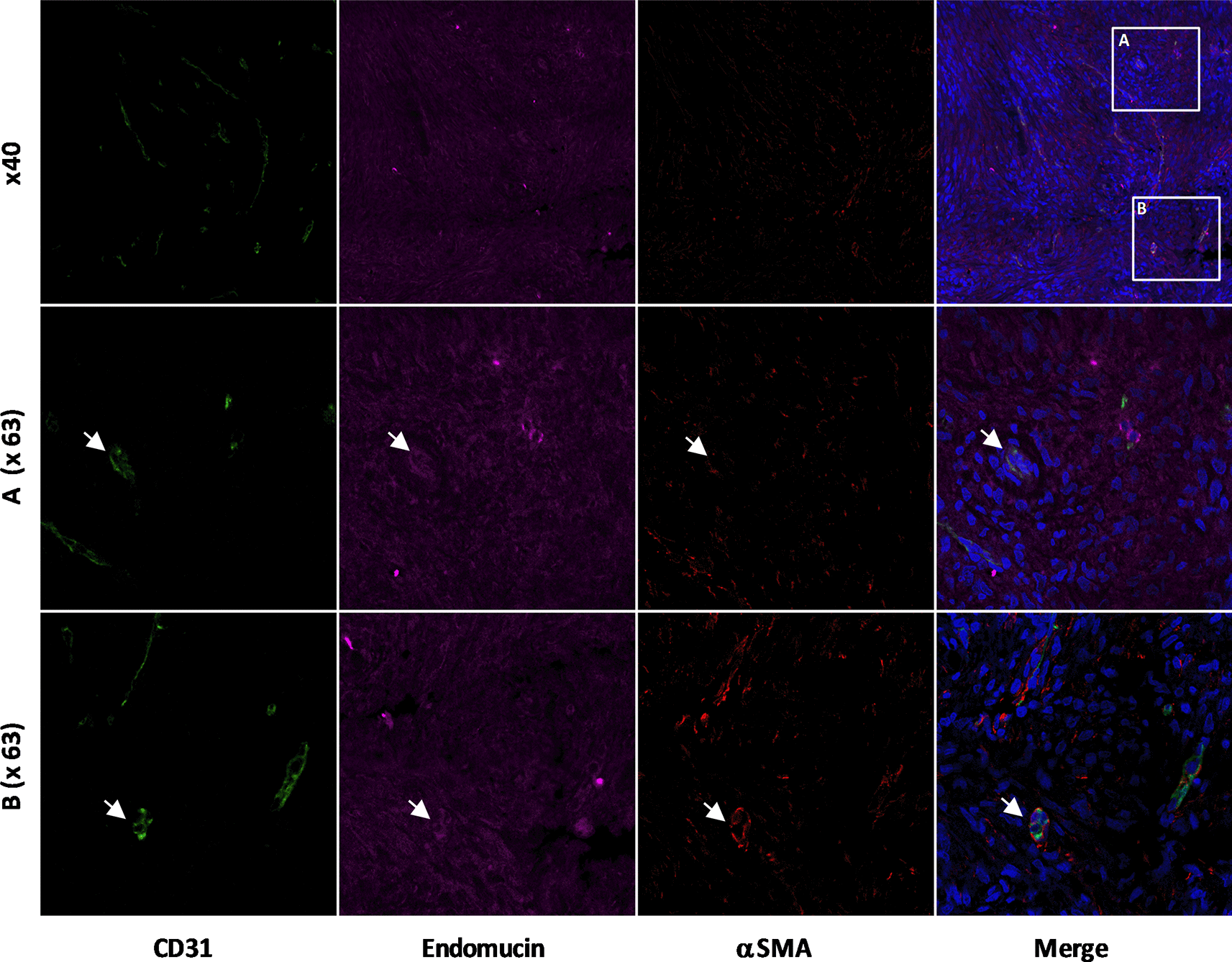 Case Report: Pathological fracture in a Li-Fraumeni... | F1000Research