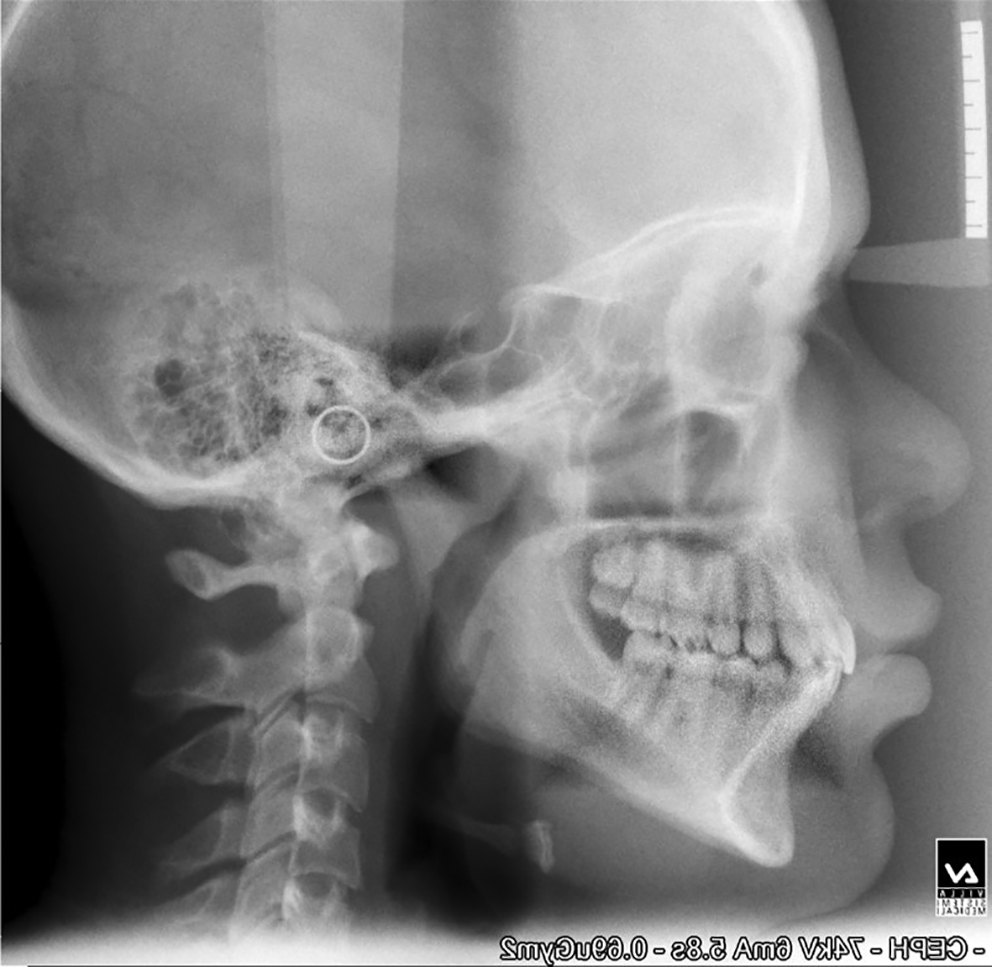 Effects of modified twin block appliance in growing... | F1000Research