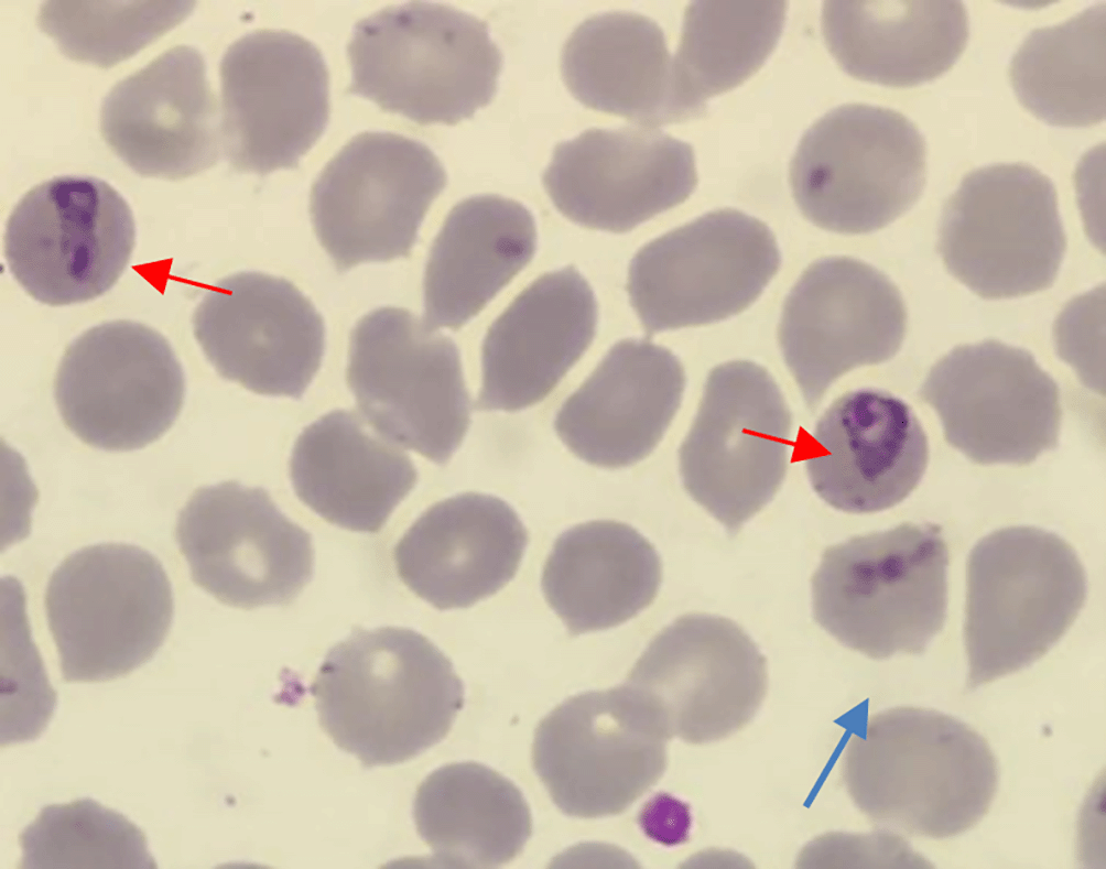 Plasmodium knowlesi infection in East Kalimantan,... | F1000Research