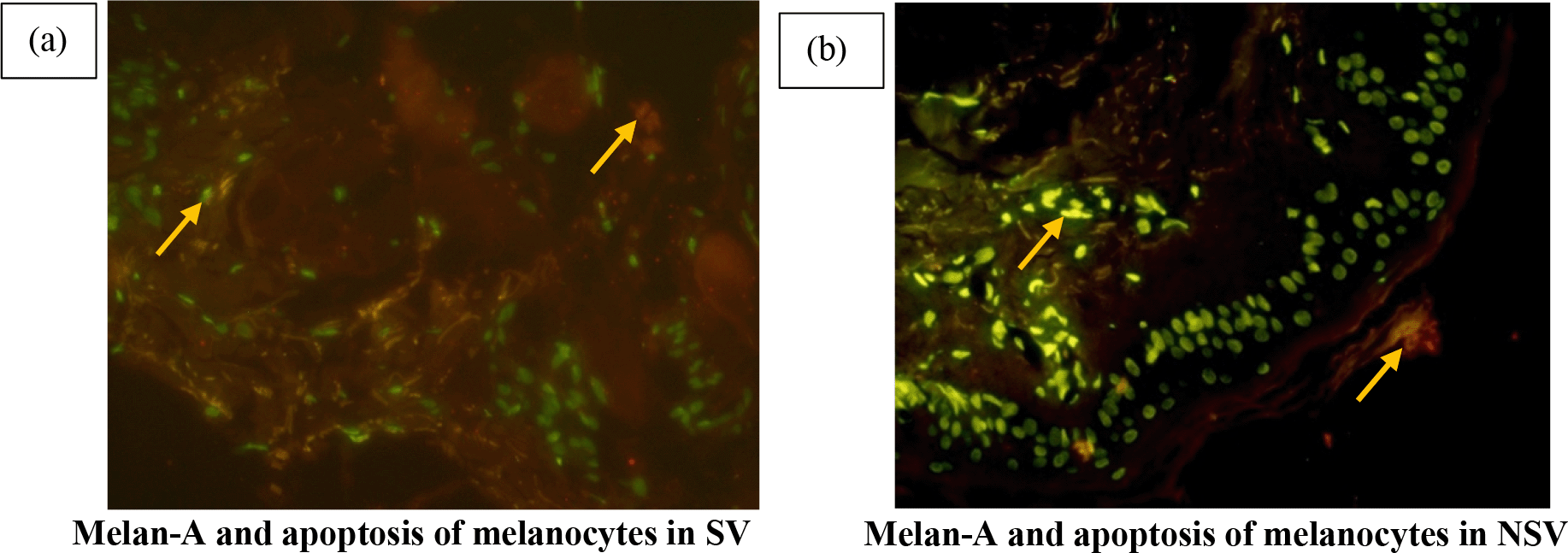 Melan-A expression related to apoptosis of... | F1000Research