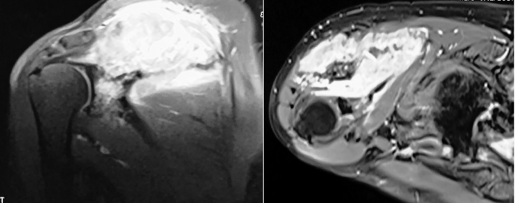 Case Report: Localized Ewing’s sarcoma of the... | F1000Research