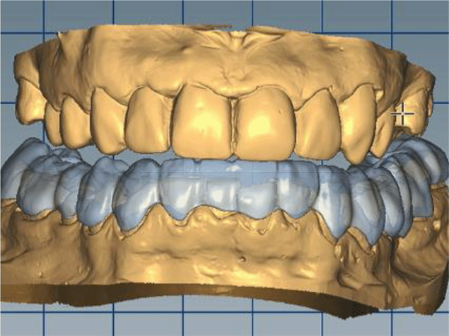 Case Report: A digital workflow in the treatment of... | F1000Research