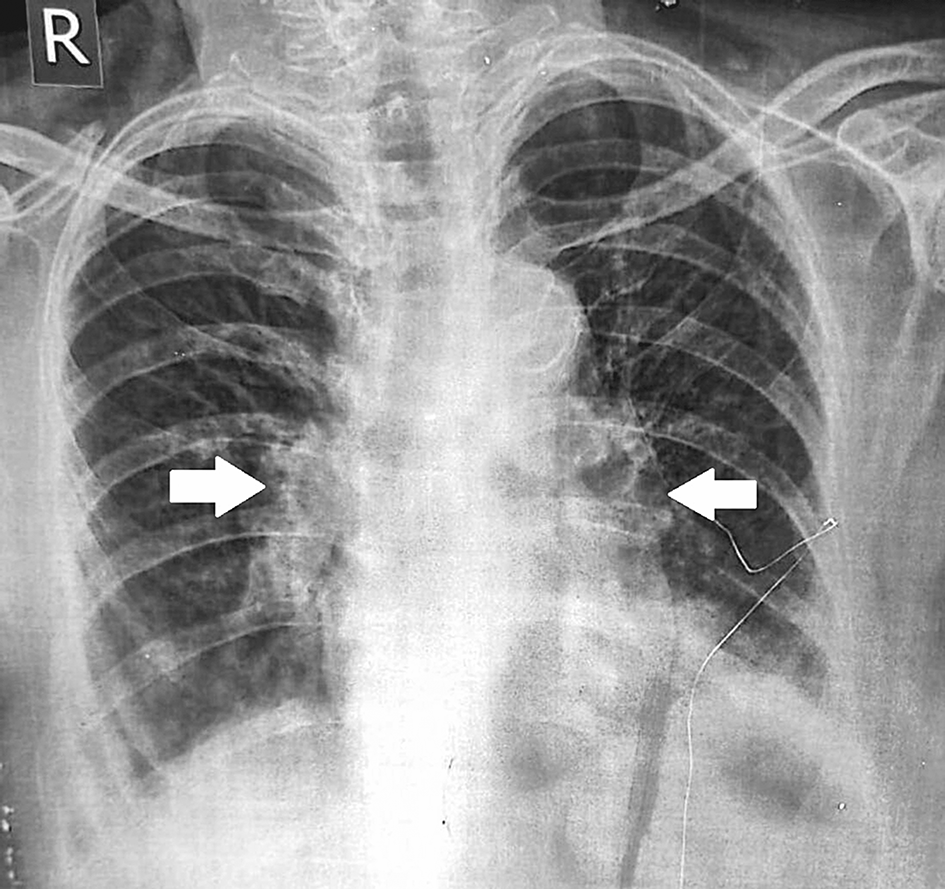 Case Report: Sarcoidosis | F1000Research