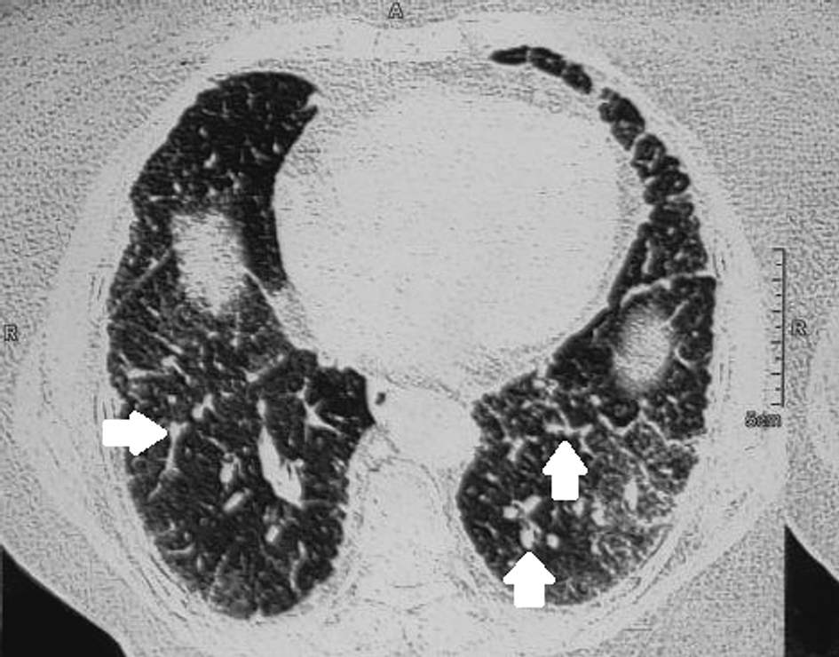 Case Report: Sarcoidosis | F1000Research