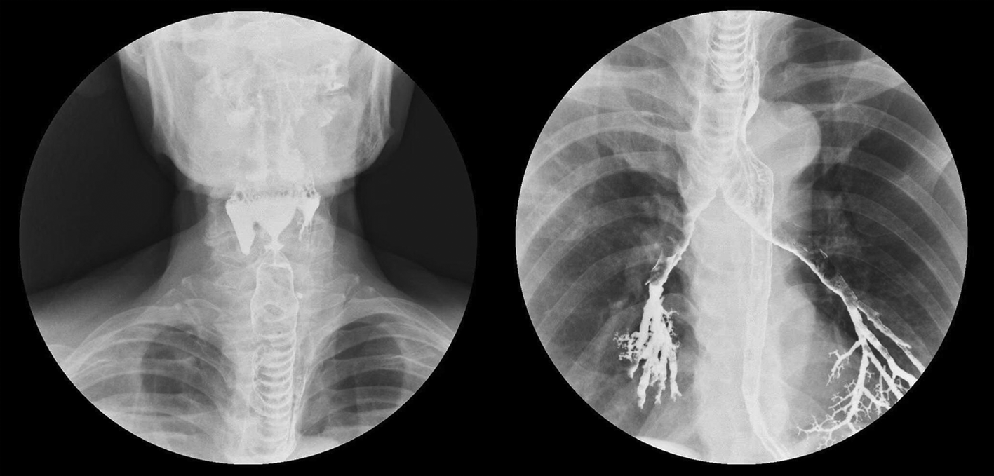 Case Report: Two-year consequences of barium... | F1000Research