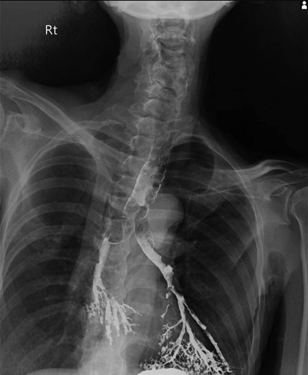 Case Report: Two-year consequences of barium... | F1000Research