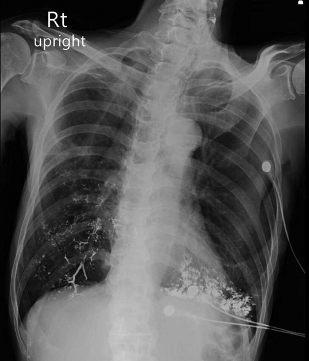 Case Report: Two-year consequences of barium... | F1000Research