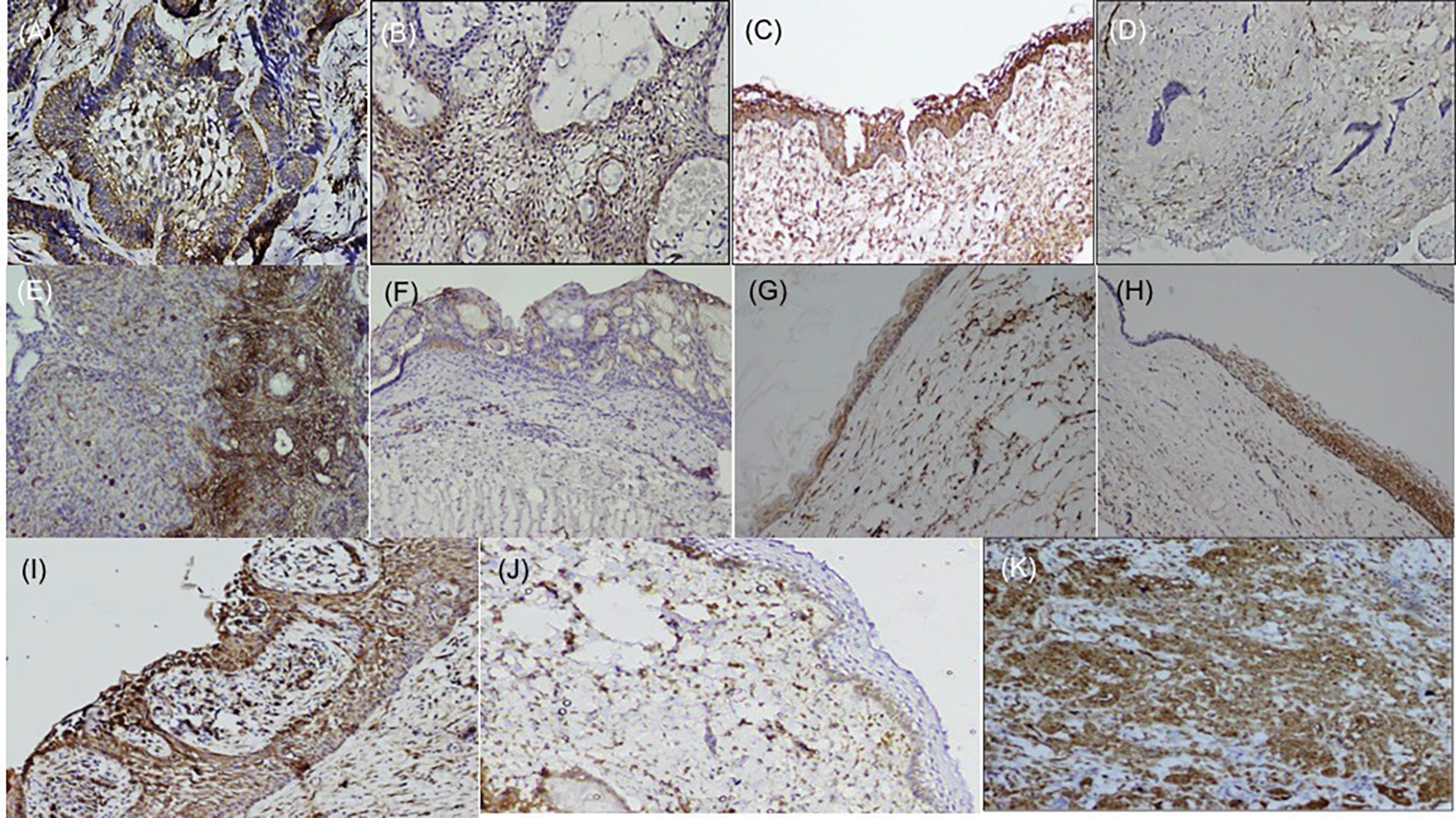 Expression of Fascin and SALL4 in odontogenic cysts... | F1000Research