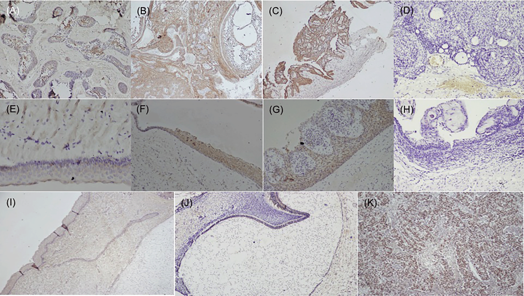 Expression of Fascin and SALL4 in odontogenic cysts... | F1000Research