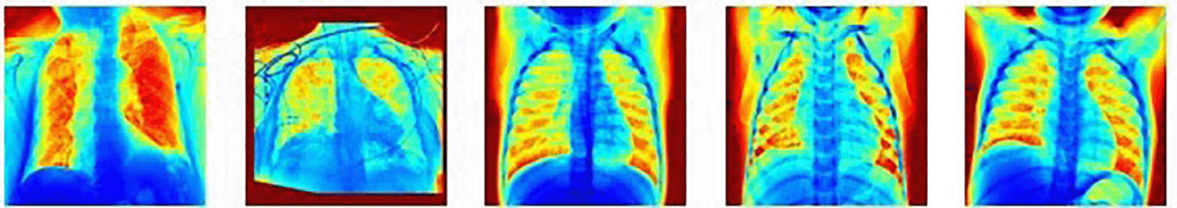 Application of Fuzzy Deep Neural Networks for Covid... | F1000Research